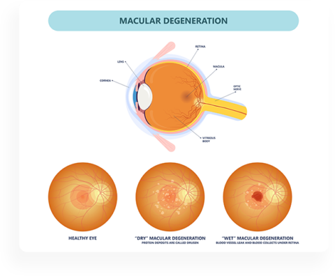 AMD Treatment in Bakersfield, CA | Li & Liao Optometry